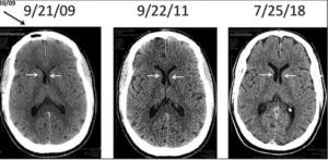 Brain Injury Images and Neuroradiology - Ogborn Mihm, LLP